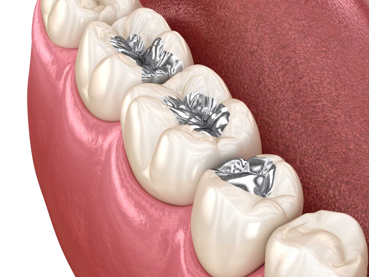 How to Choose the Right Type of Tooth Filling for Your Needs