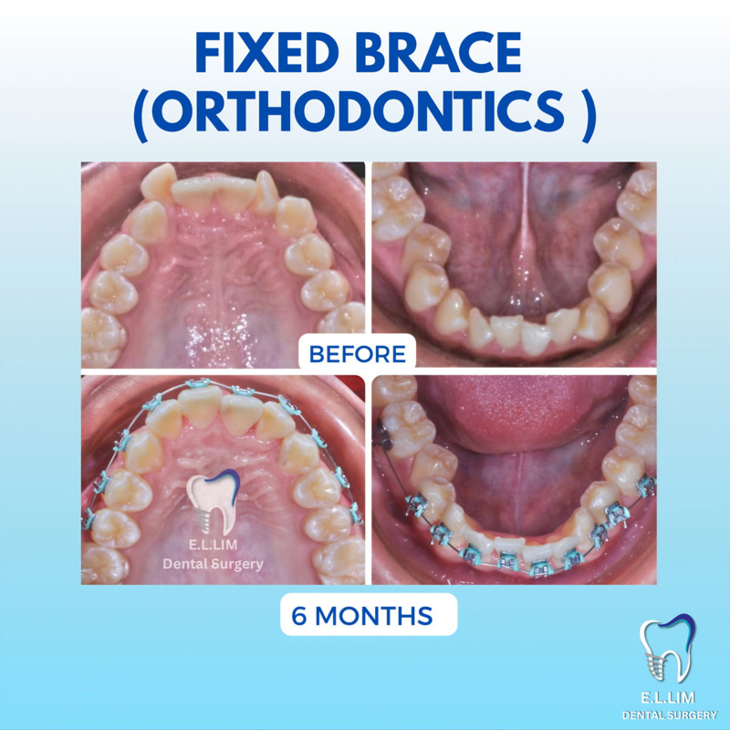 Understanding Braces Price in Malaysia: Types, Costs, and What to Expect